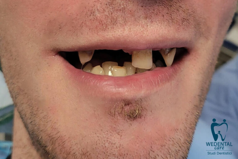 Paziente edentulo | I Casi Clinici di Wedental Care
