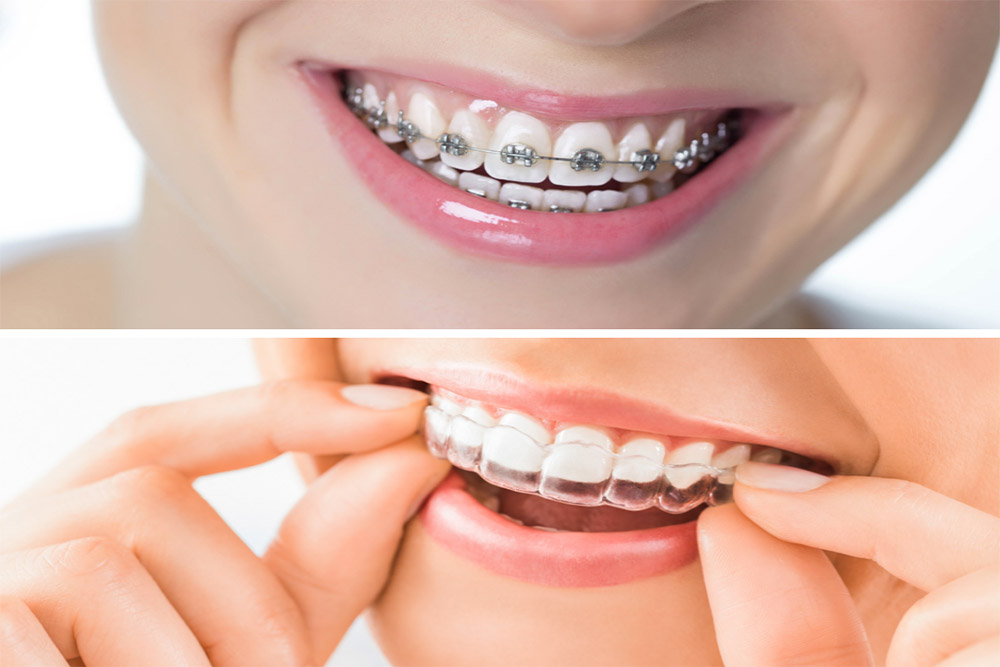 Guida all'apparecchio denti fisso e invisibile | Wedental Care Guida all'apparecchio denti fisso e invisibile | Wedental Care